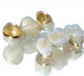 Porcelain Fused to Metal – Idea-Dental Cosmetic Dentistry