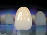 All Ceramic – Idea-Dental Cosmetic Dentistry